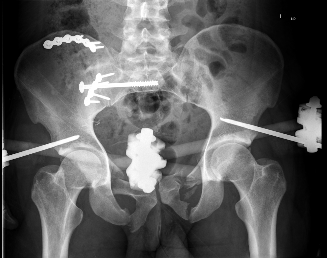 Vertical Shear | The Bone School